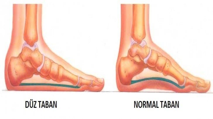 Düz Tabanlık ve İçe Basma - Op. Dr. Selim Muğrabi