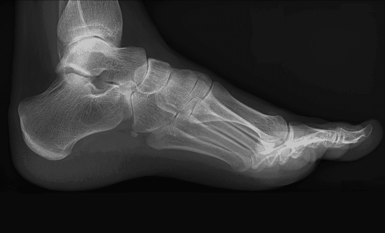 Pes Cavus (Yüksek kavis) - Nedir, Belirtileri Nelerdir?